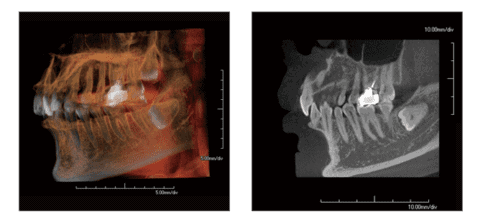Prexion3D Excelsior CBCT | Alliance Dental Solutions